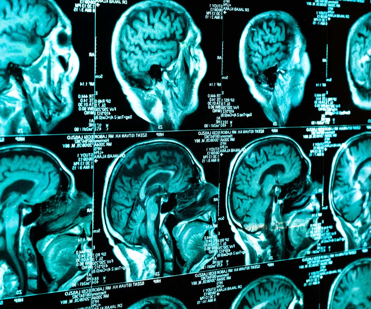 Neuroplasticity | Arrowsmith